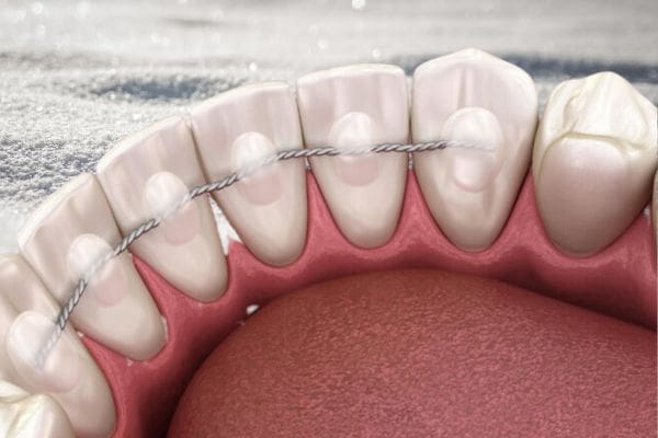 The Importance Of Retainers After Braces